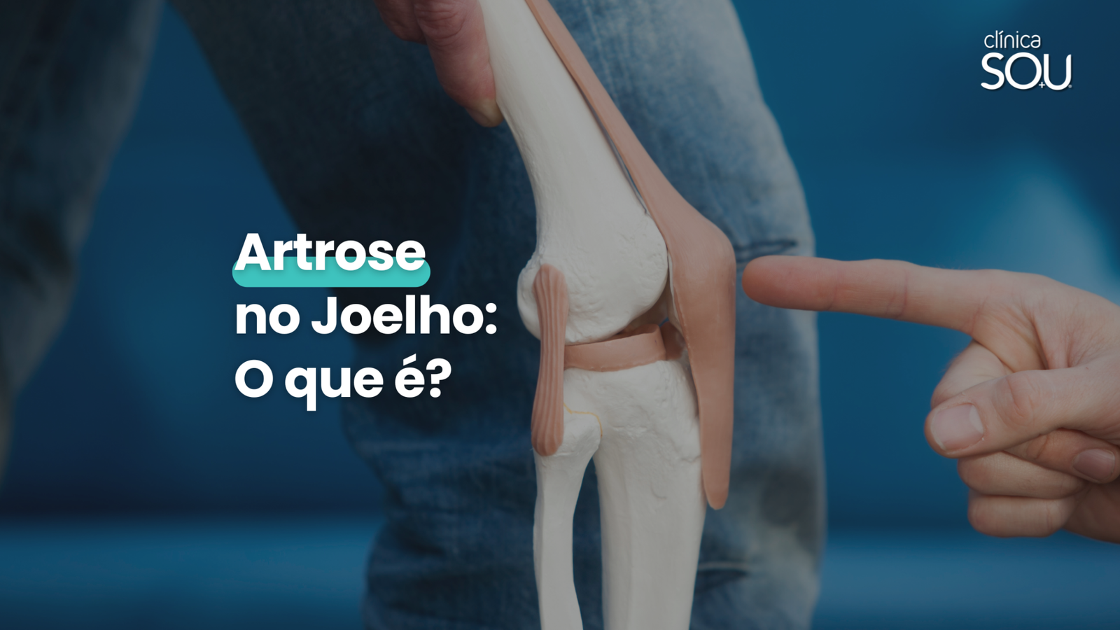 Artrose no Joelho: O que é? - SOU Clínica